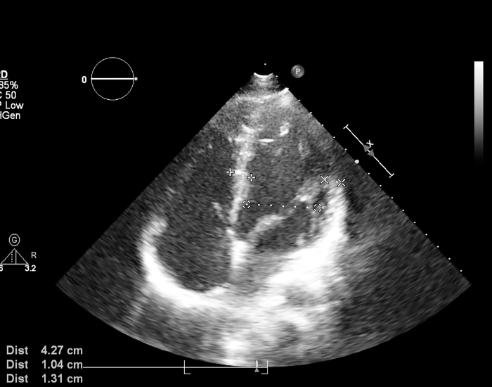 Transesophageal Echocardiogram (TEE) in Katy TX | Advanced Cardiology ...
